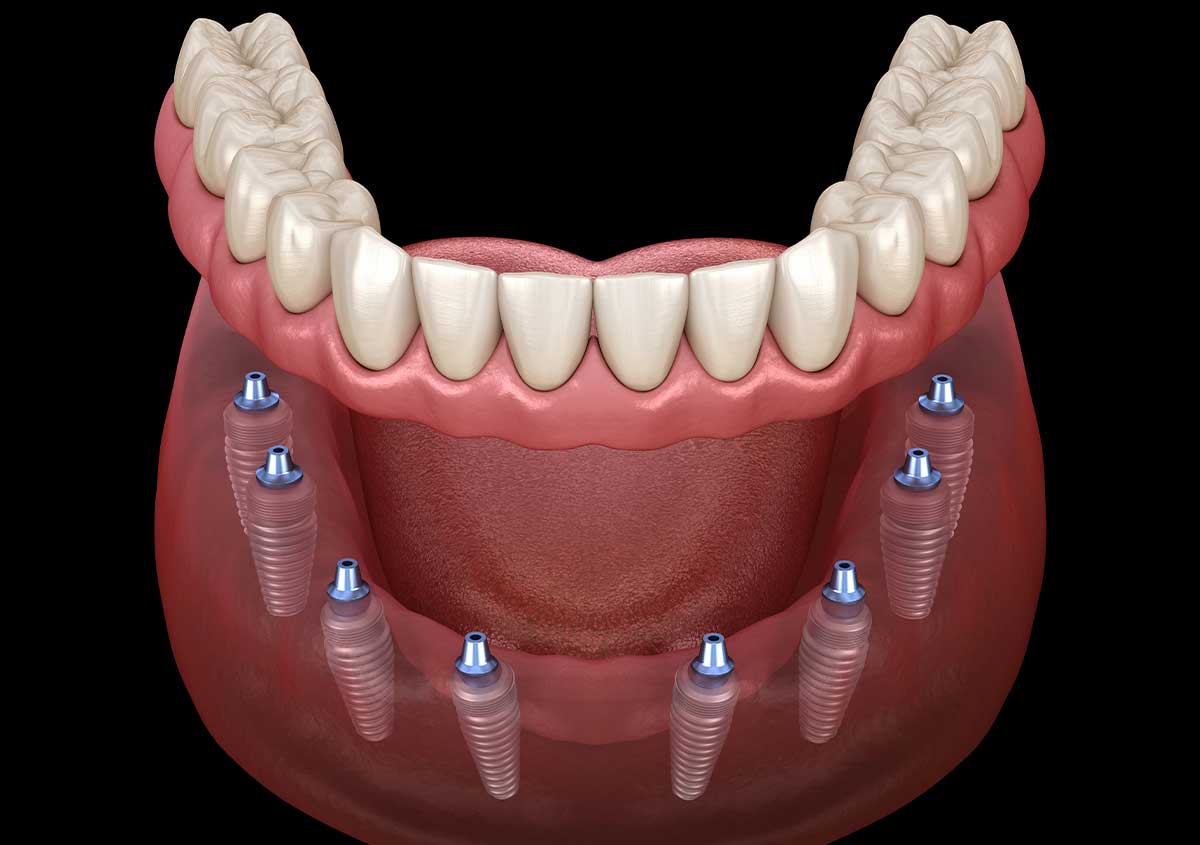 Discover the Advantages of All-on-x Dental Implants Over Other Options ...